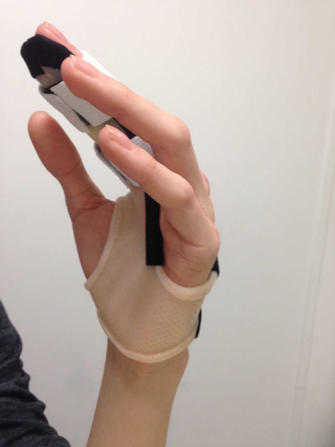 Fracture de phalange - L'Orthesiste.fr