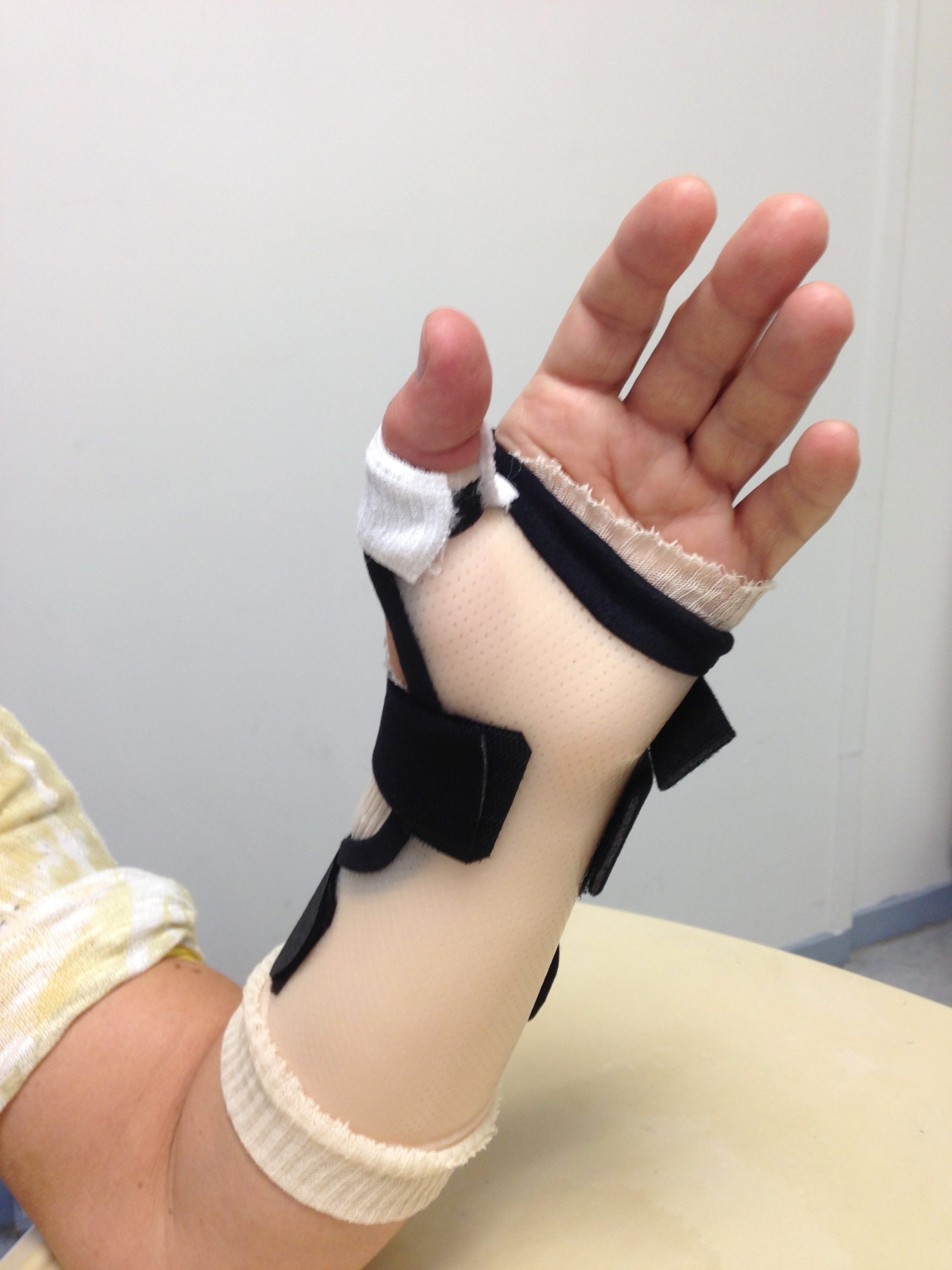 Ténosynovite de De-Quervain - L'Orthesiste.fr