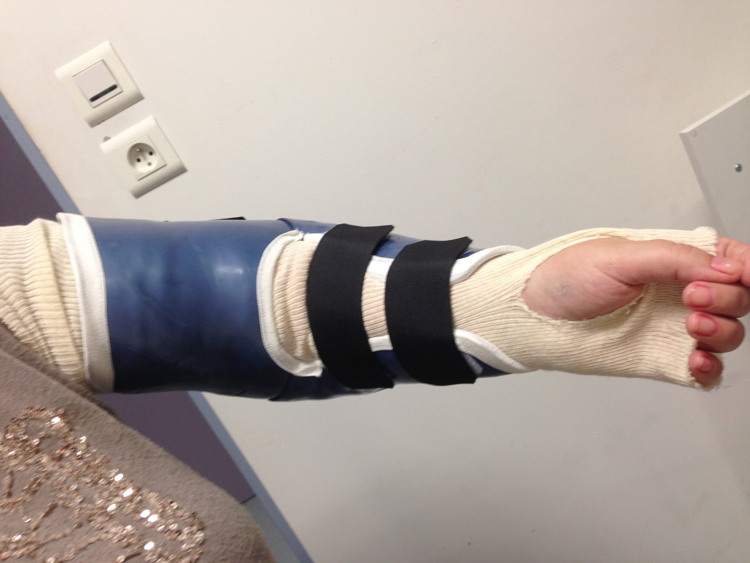 Fracture du coude – L'Orthesiste.fr