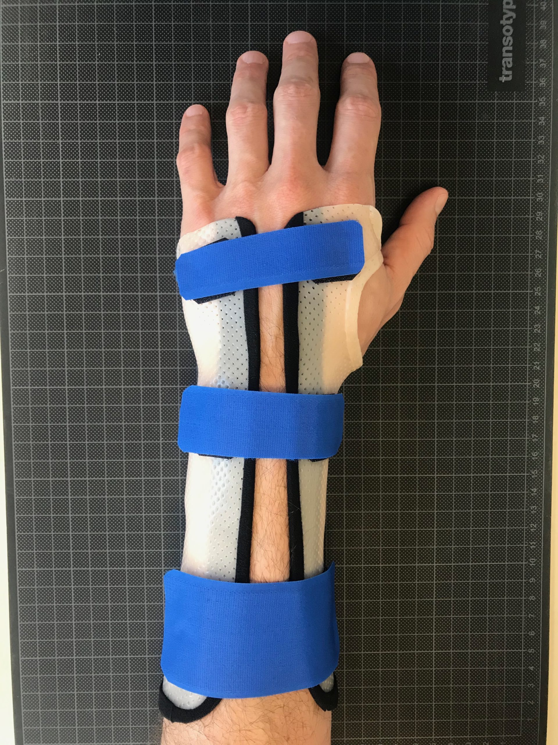 Epitrochléite – L'Orthesiste.fr