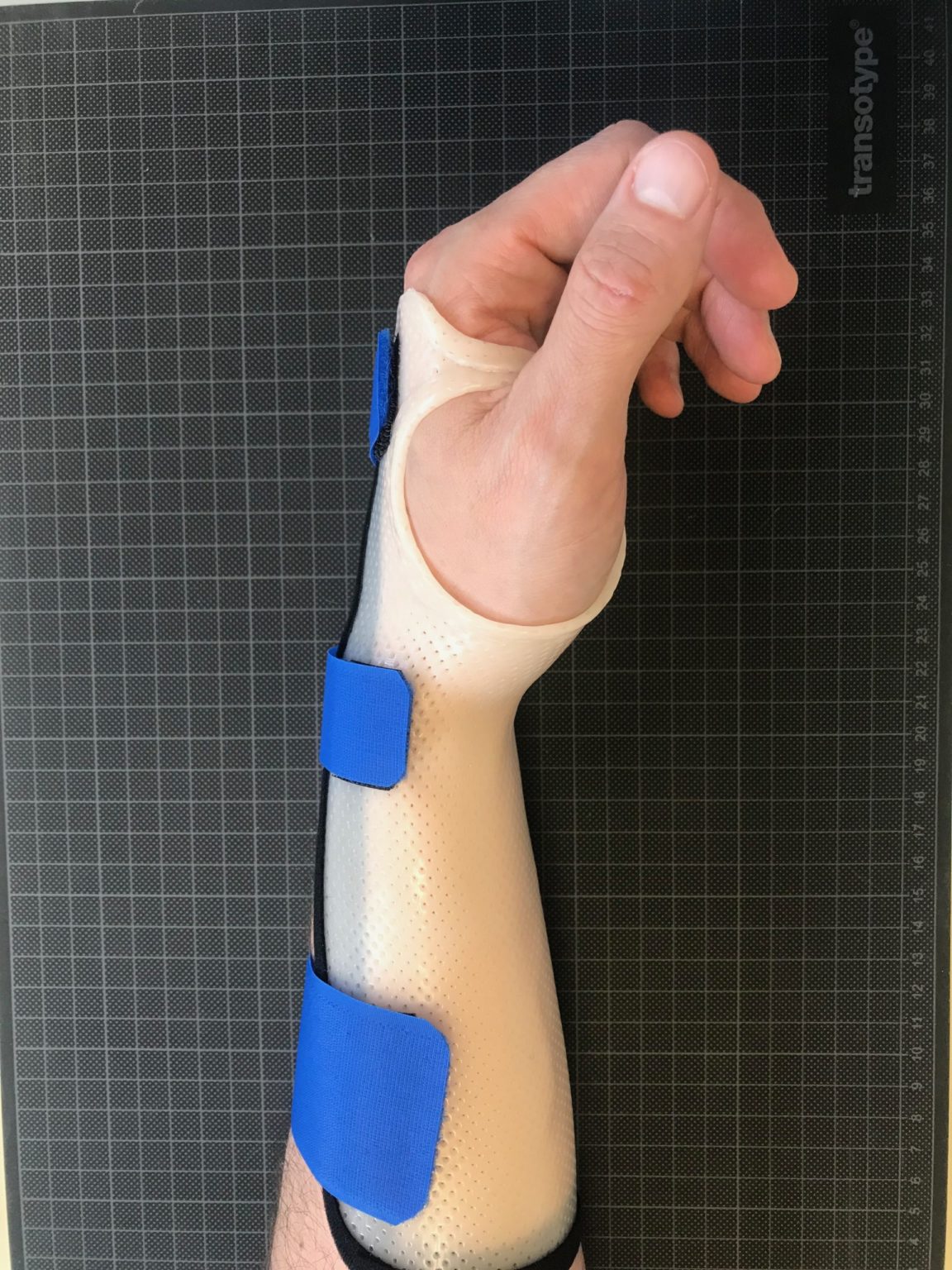 Epitrochléite - L'Orthesiste.fr